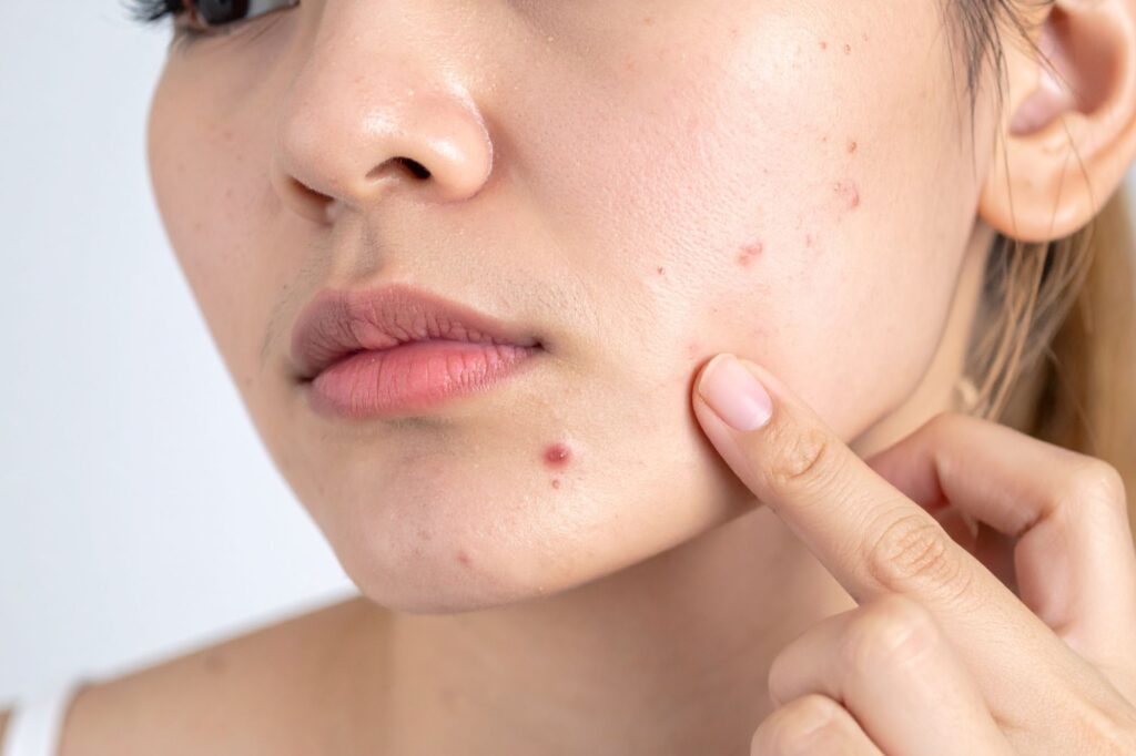 Blind Pimple Treatment: Causes, Remedies & Expert Solutions